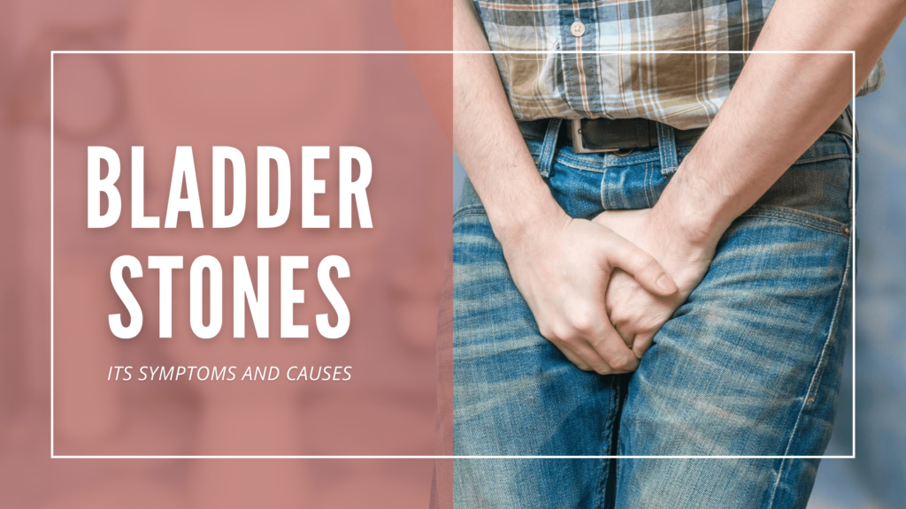 What are Bladder Stones? Its Symptoms Causes and Treatment