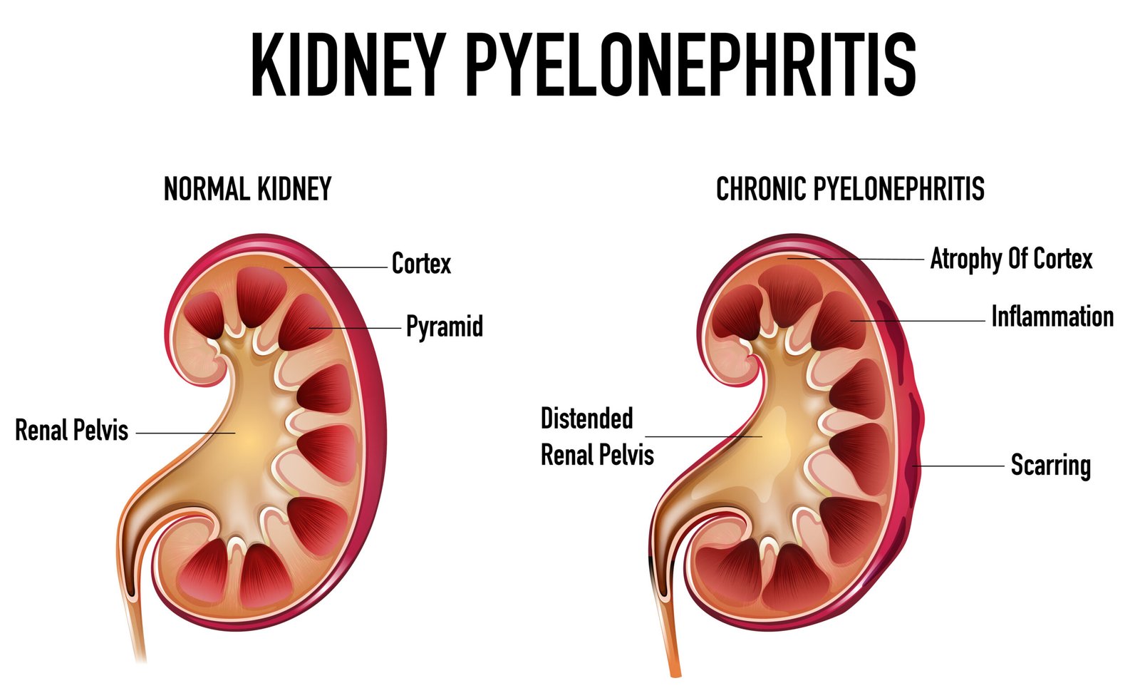 What Is Pyelonephritis Kidney Infection 