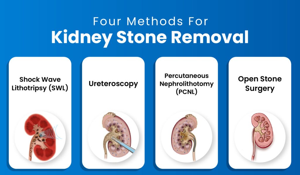 Do I Need Surgery for Kidney Stone?