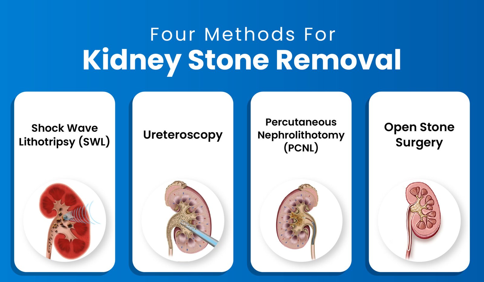 Do I Need Surgery for Kidney Stone?