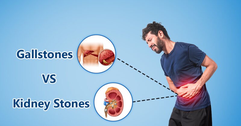Effective Home Remedies for Kidney Stones - Urologist Ahmedabad
